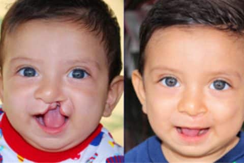 Global Smile Foundation | Universal Cleft Care Access