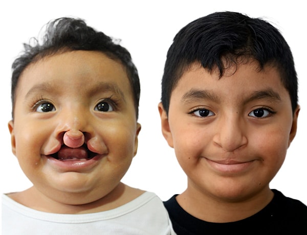 Amir - Global Smile Foundation