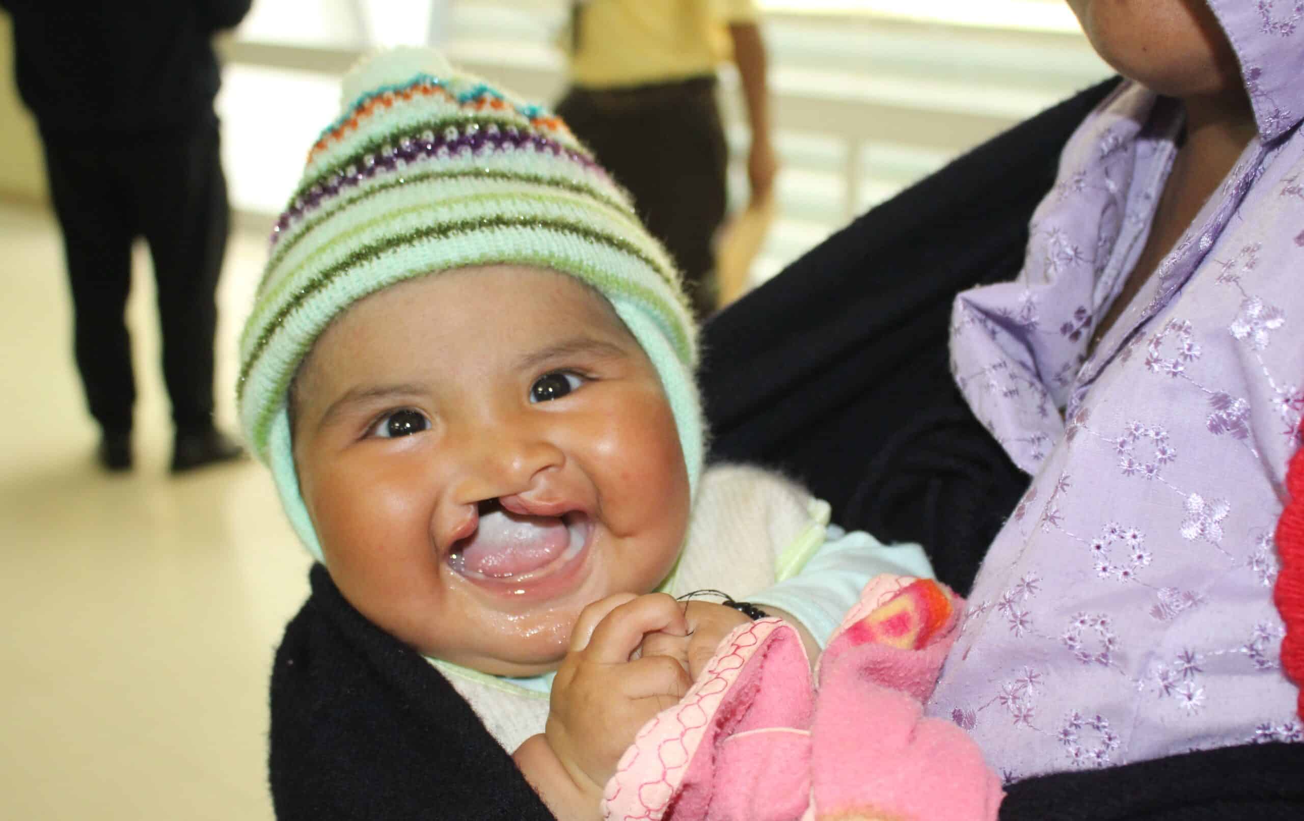 Support Smiles Now | Global Smile Foundation | Cleft Care