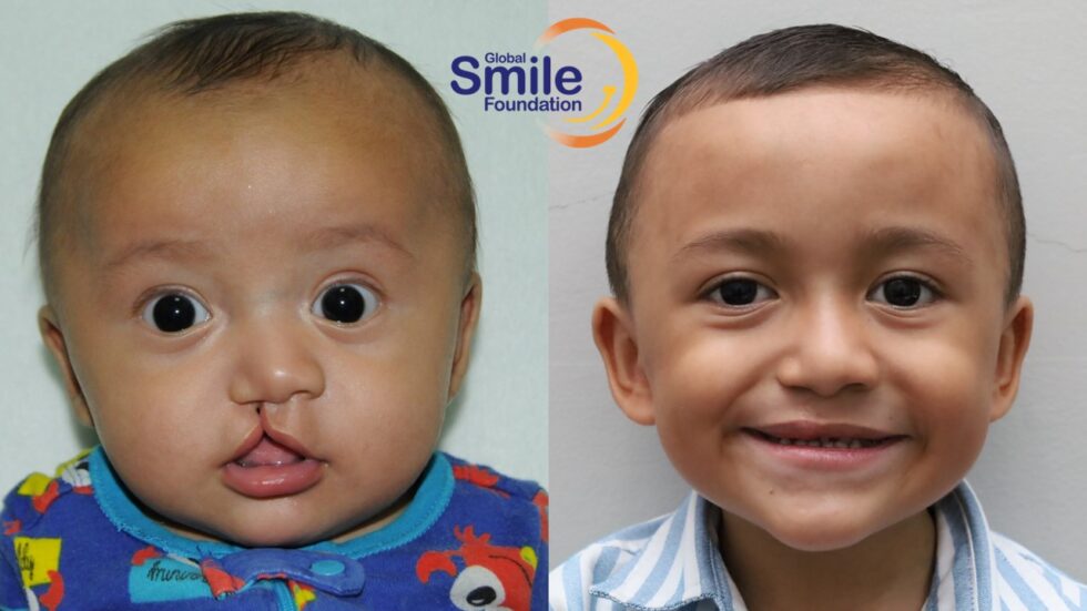 Our Cleft Care Patient Gallery | Global Smile Foundation