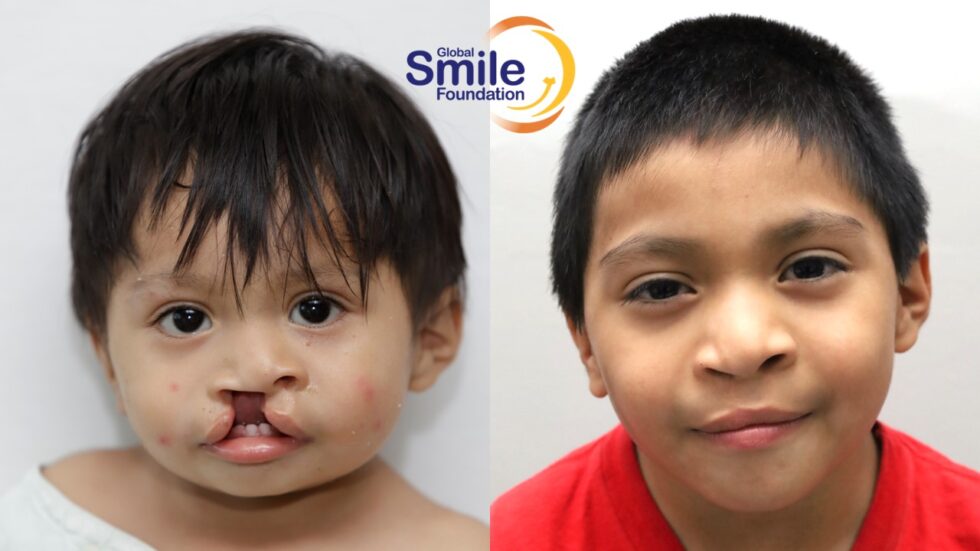 Our Cleft Care Patient Gallery | Global Smile Foundation