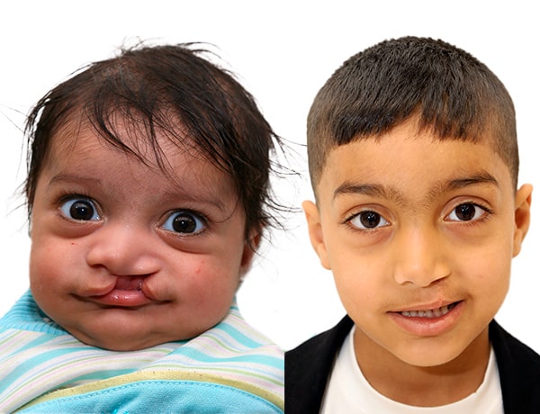 Ali - Global Smile Foundation